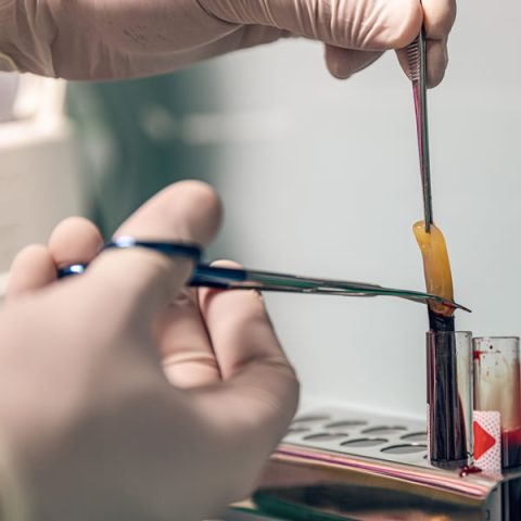 PRP i PRF za kronične rane - High Care Medical Centar